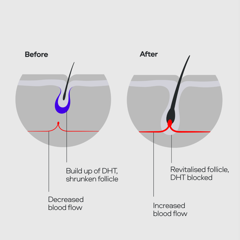 Buy Topical Finasteride & Minoxidil for Hairloss | Sons UK